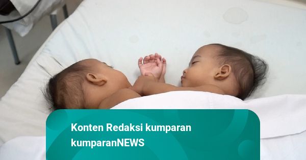 RSUP Adam Malik Medan Berhasil Pisahkan Bayi Kembar Dempet | kumparan.com